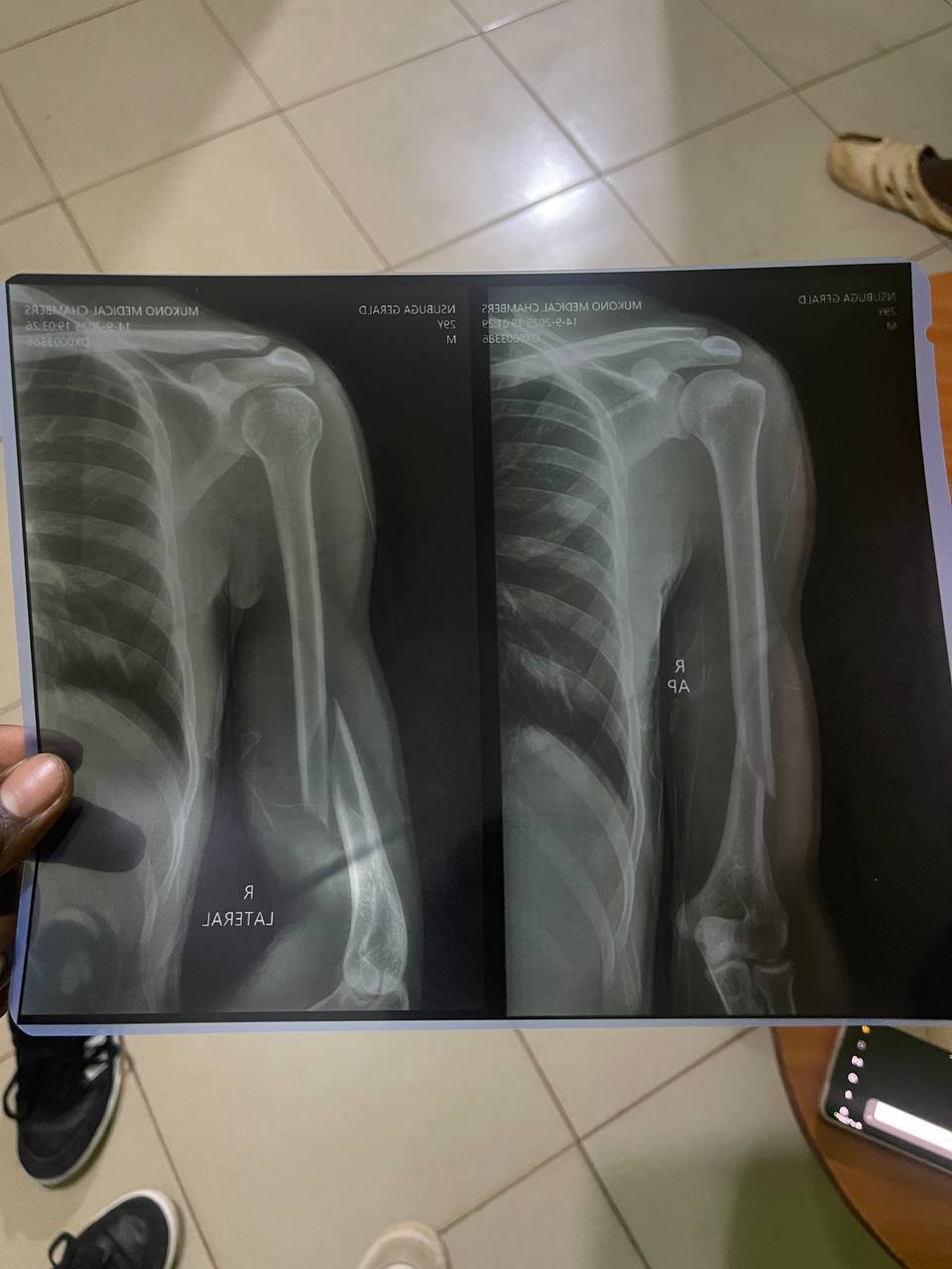 Donate Towards Gose Gerald’s Arm Surgery | Uganda Skateboard Society ...